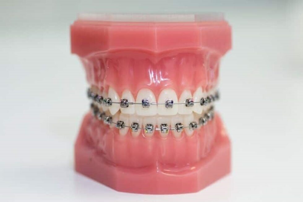 Teeth Grinding & Braces: Prevention Tips for a Healthy Smile
